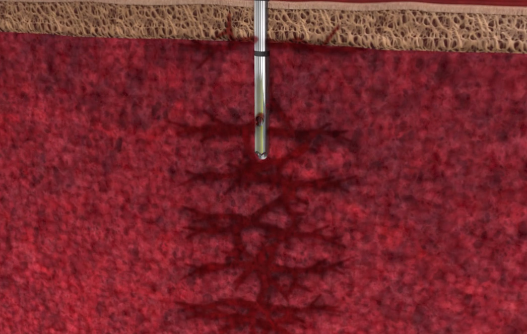 Bone Marrow Aspirate – CAREstream America